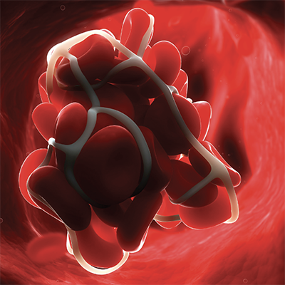 Optical and Mechanical Clot Detection Methodologies
